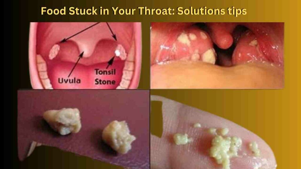 Food Stuck In Your Throat Effective Home Remedies And Tips Wellnessuniverse